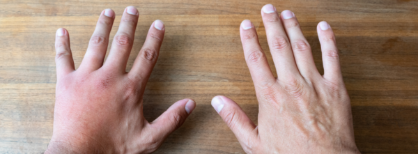 What You Need to Know About Soft Tissue Injuries | Steinger, Greene ...